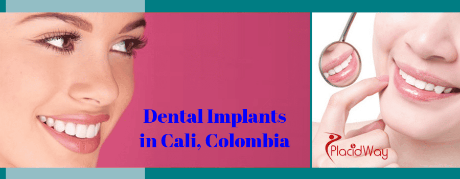 Affordable Dental Implants in Cali, Colombia - Complete Package