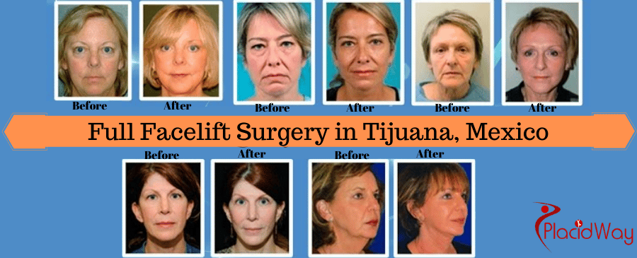 Full Face Lift in Tijuana, Mexico- Affordable Cost