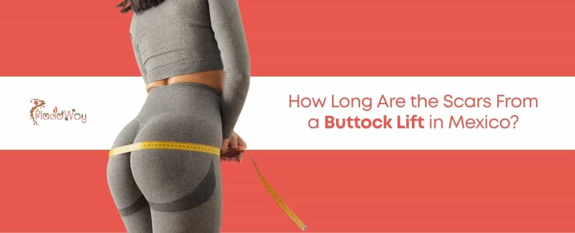 Buttock Lift Scars in Mexico: What to Expect