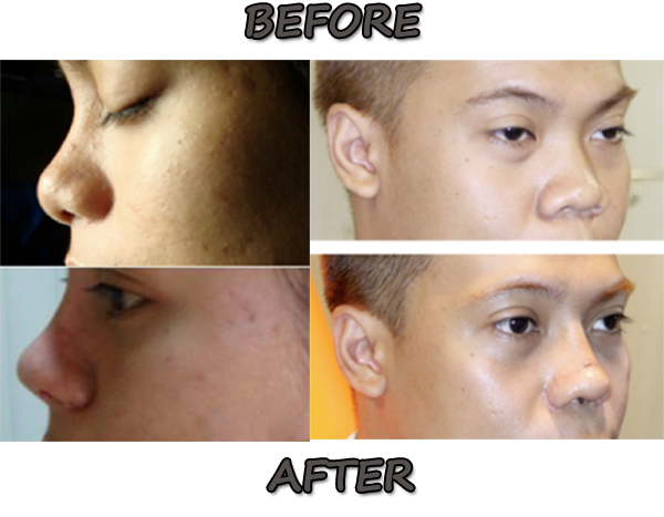 Filipino Nose Job Before And After