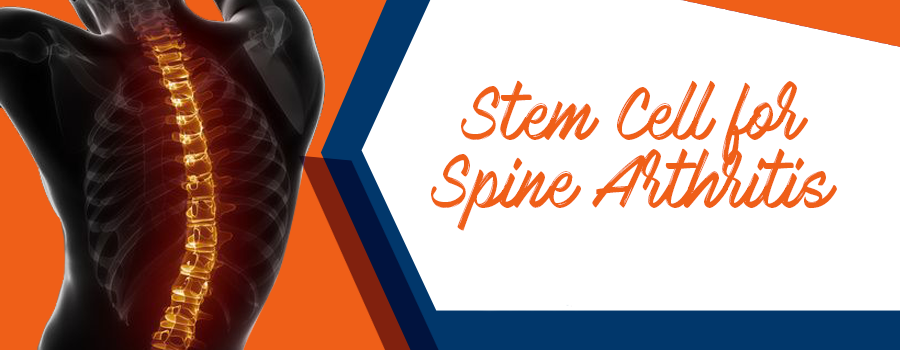 Stem Cell Therapy for Spine Arthritis Abroad